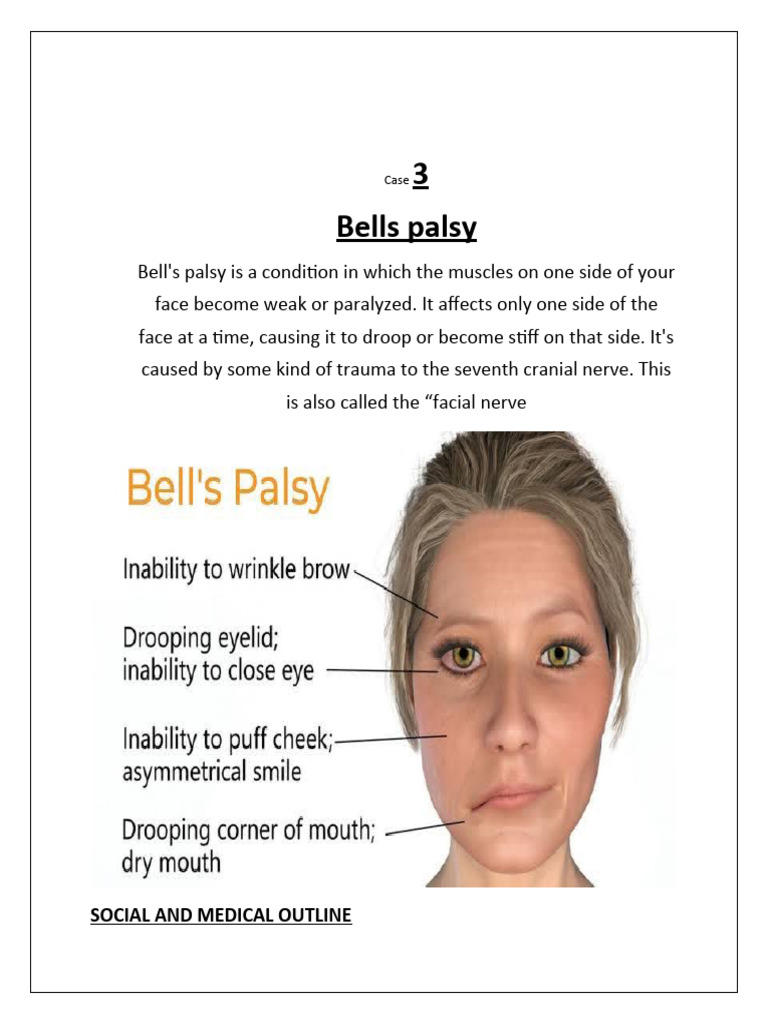 Bells Palsy Aisha8 | Download Free PDF | Dementia | Pain