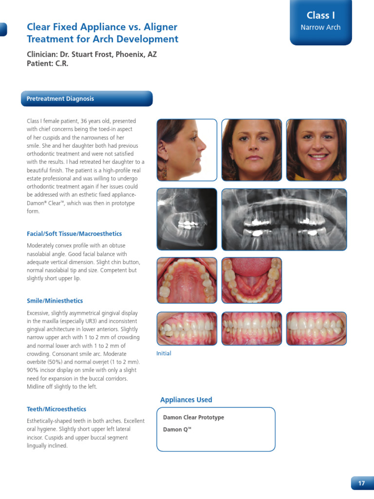 Damon System Cs Class I Nonextraction CR | PDF | Orthodontics ...