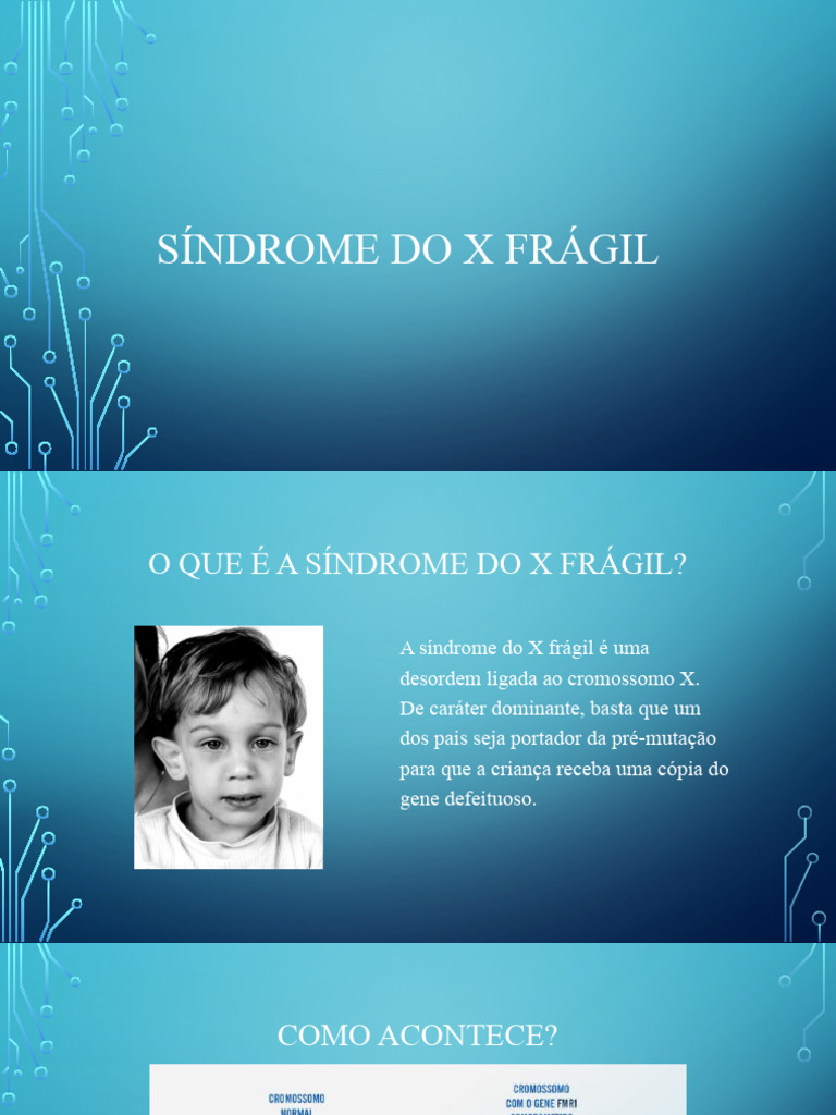 Características da Síndrome do X Frágil | PDF | Causas de morte ...