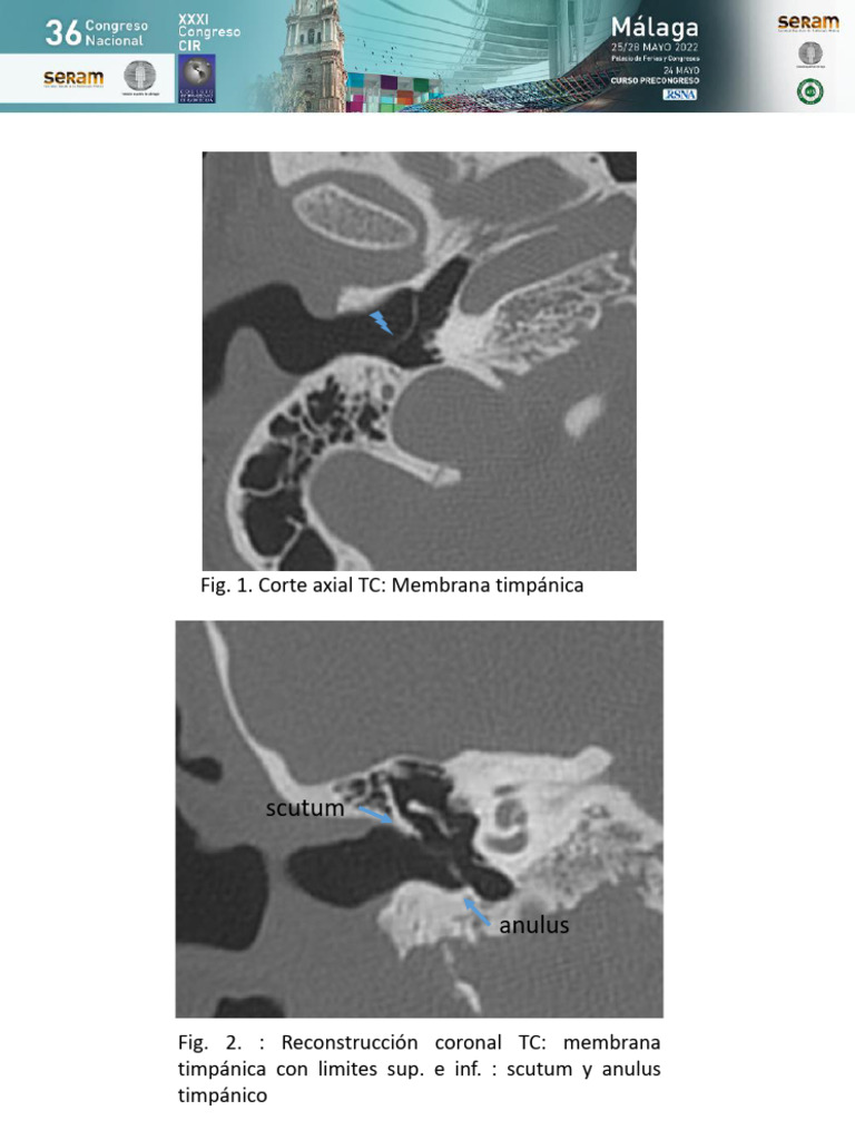 Anatomía Del Oído TC IMAGENES | Descargar gratis PDF | Escuchando ...