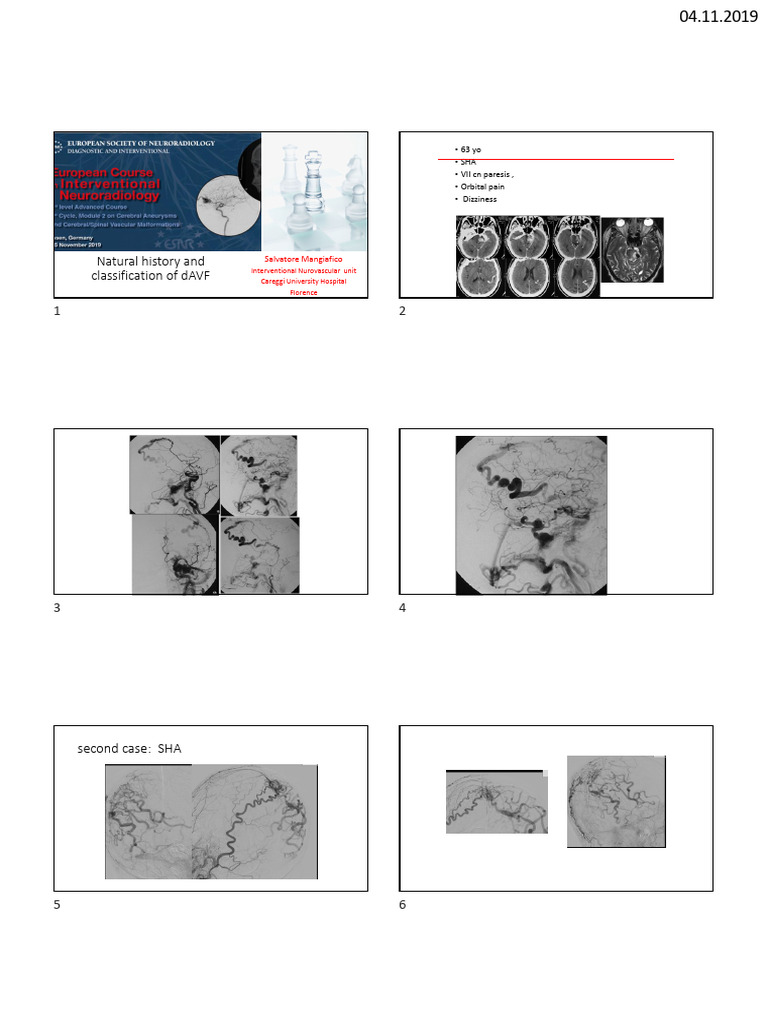 73075-Natural History and Classification of Davf | PDF | Vein | Thrombosis