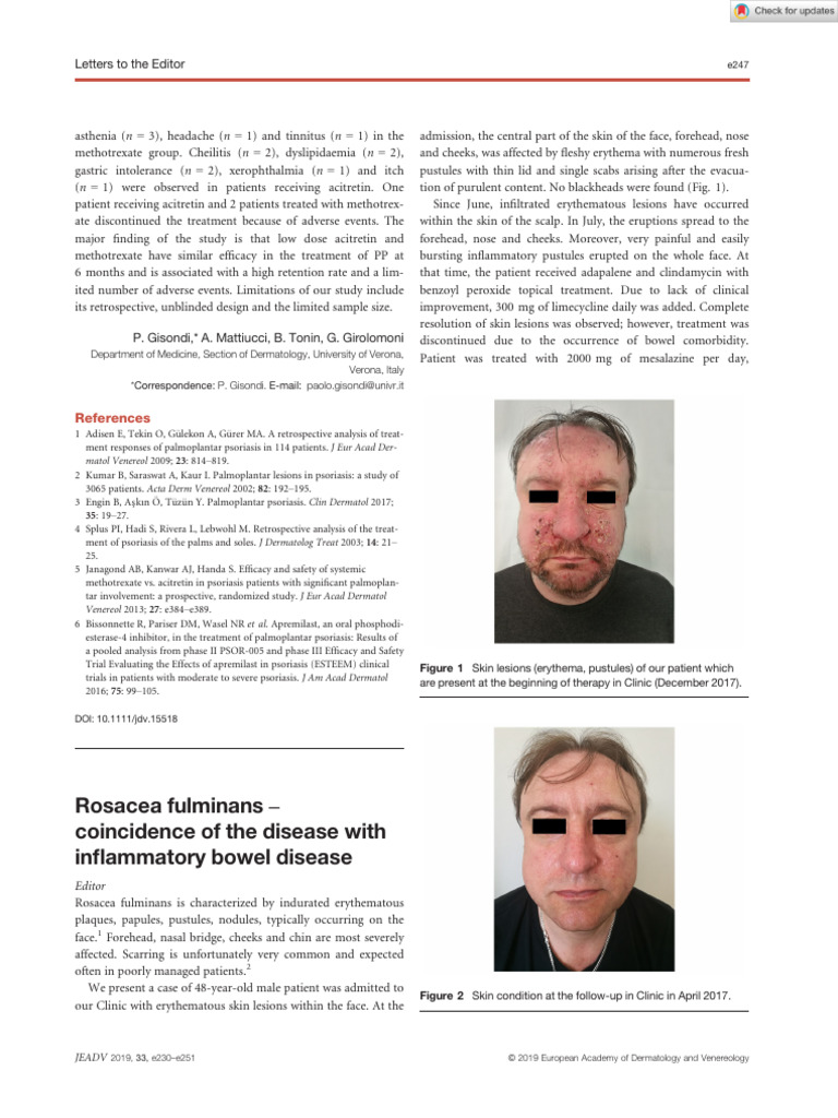 Acad Dermatol Venereol - 2019 - Nowak - Rosacea Fulminans Coincidence ...