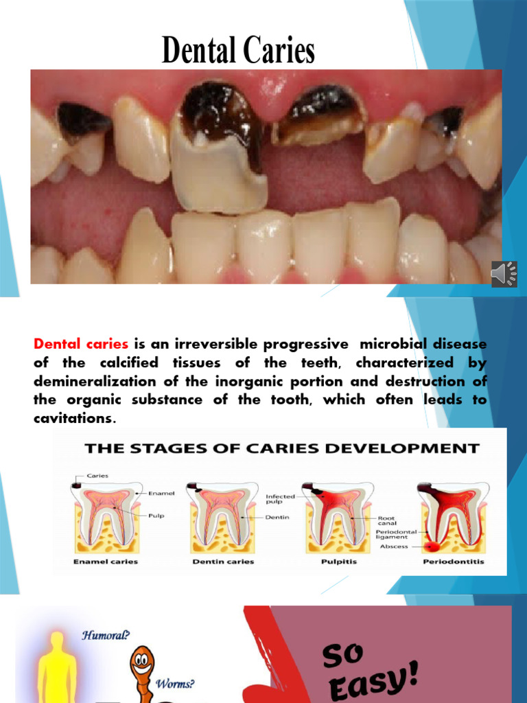 1- Theories of Dental Caries | PDF