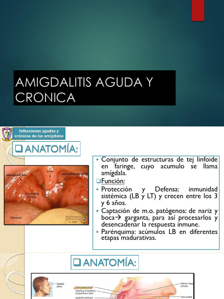 Amigdalitis Aguda y Cronica | PDF | Enfermedades y trastornos | Medicina CLINICA