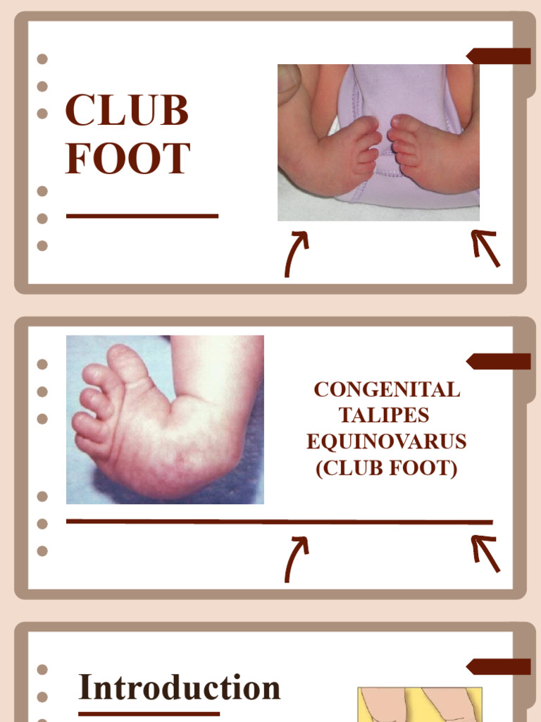 Club Foot | PDF