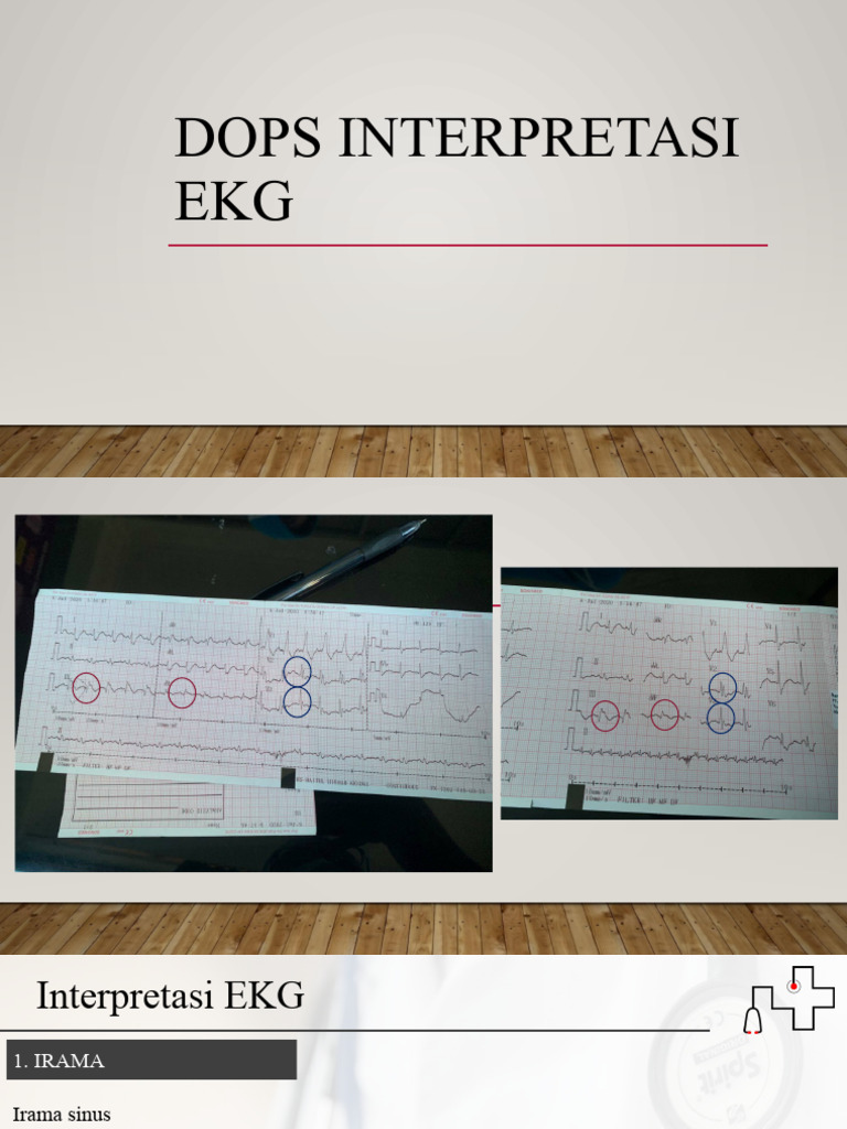 Dops Interpretasi Ekg. | PDF