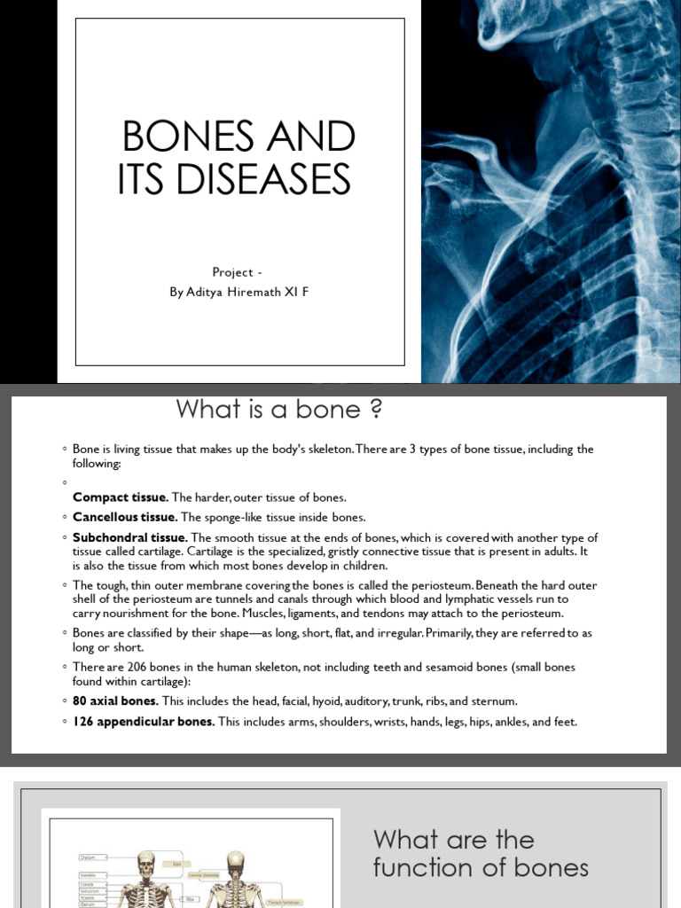 Bones and Its Dieases | PDF | Bone | Osteoporosis
