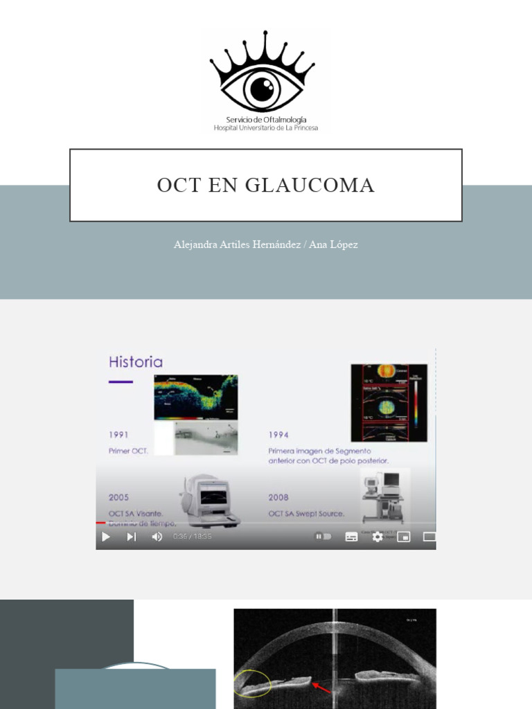 OCT en Glaucoma | PDF