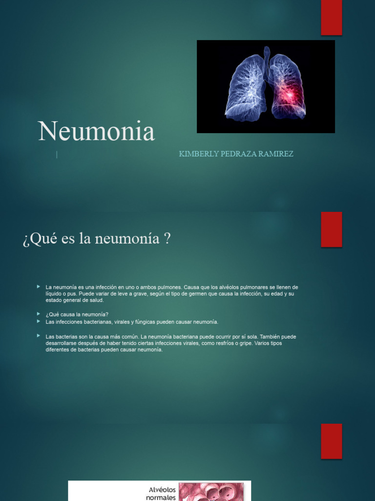 Neumonia | PDF | Neumonía | Enfermedades respiratorias