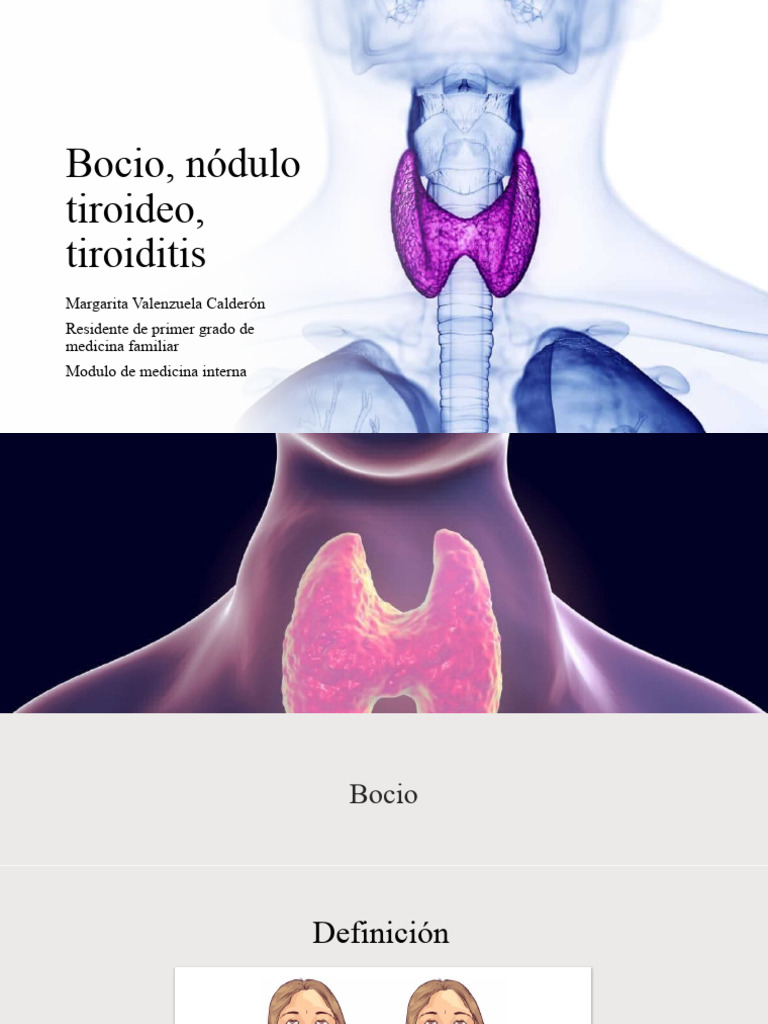 Bocio, nódulo tiroideo, tiroiditis | PDF | Tiroides | Especialidades ...