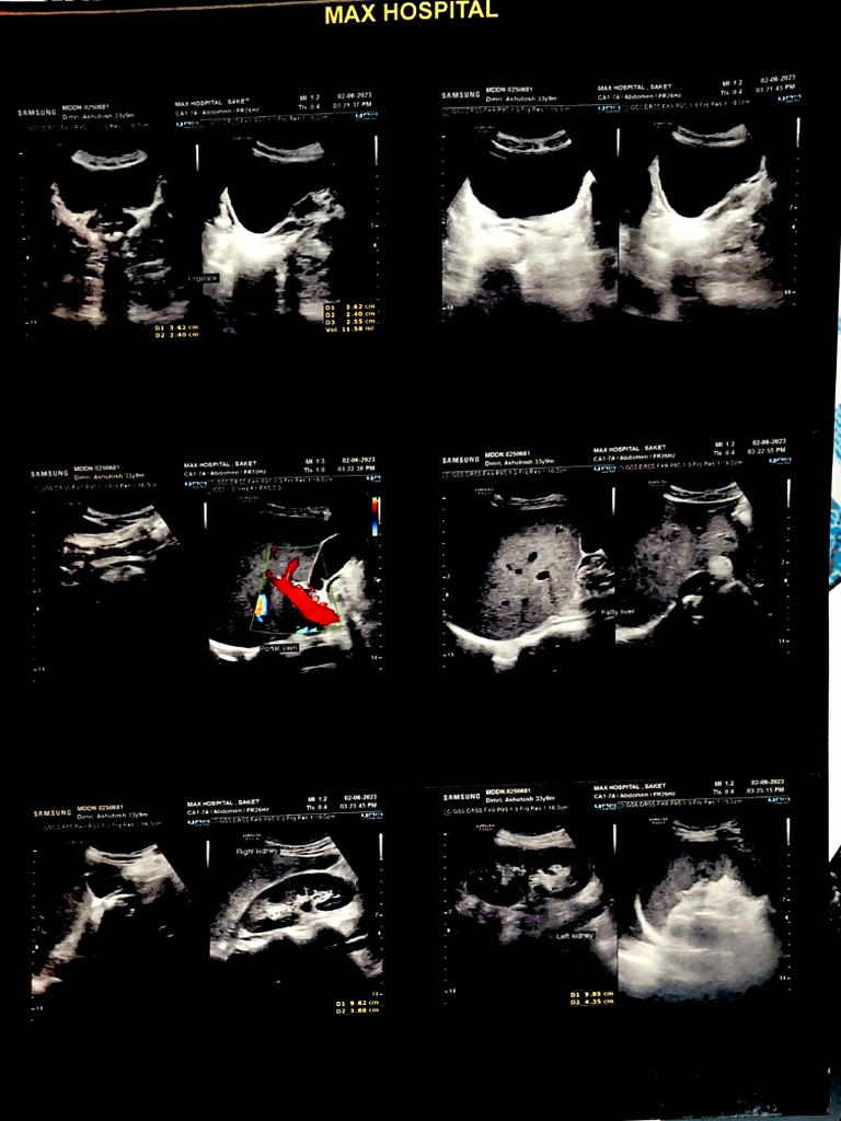 USG Whole Abdomen | PDF