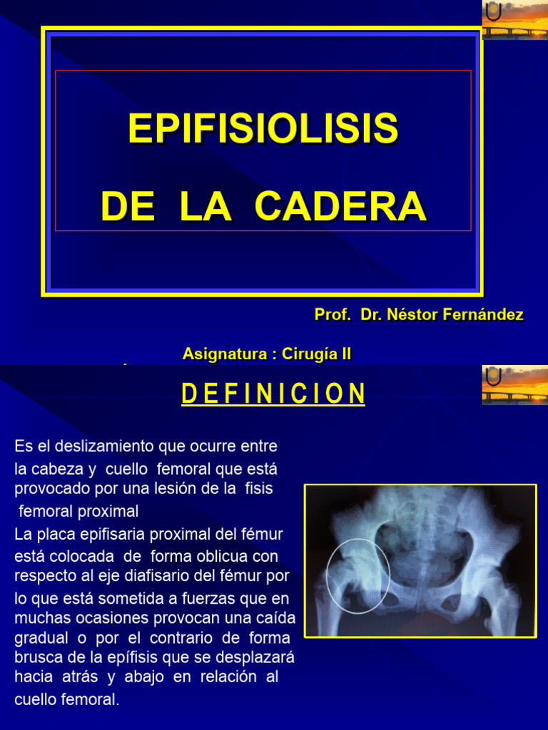 Epifisiolisis de Cadera: Definición y Tratamiento | PDF | Rodilla ...