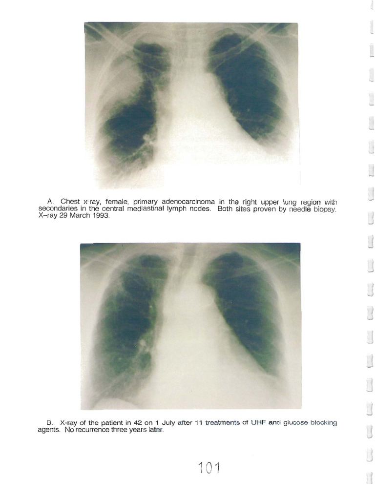 Essentials of Cancer 4 | PDF