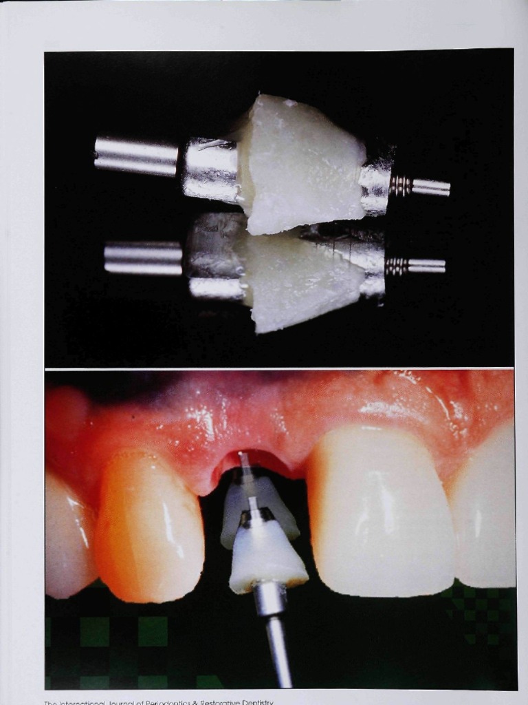 文獻2 Custom impression coping for an exact registration of the healed ...