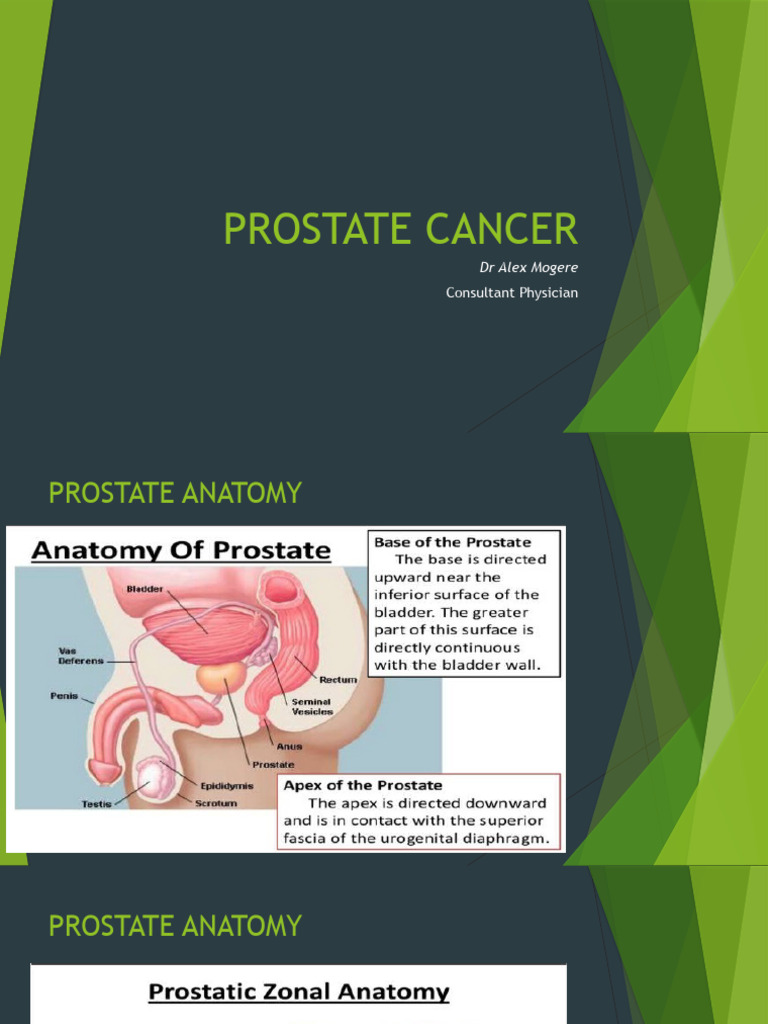 Prostate Cancer | PDF | Prostate Specific Antigen | Prostate Cancer
