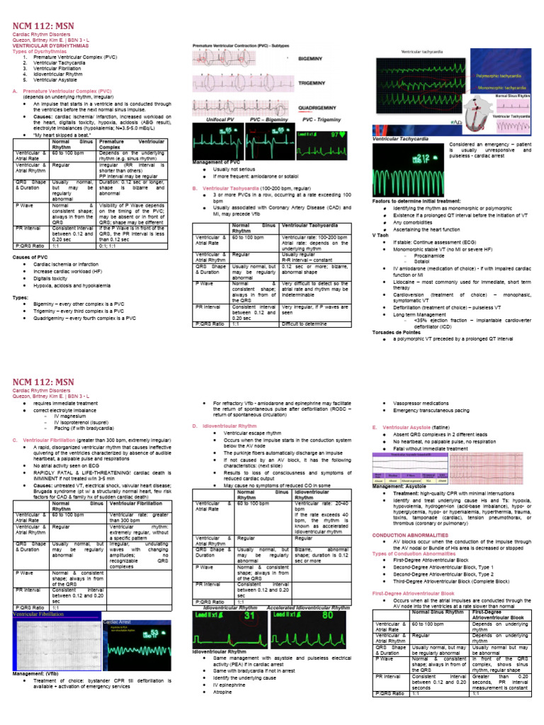 NCM 112 MSN Prelim Topic 4 Cardiac Rhythm Disorders | PDF | Causes Of ...