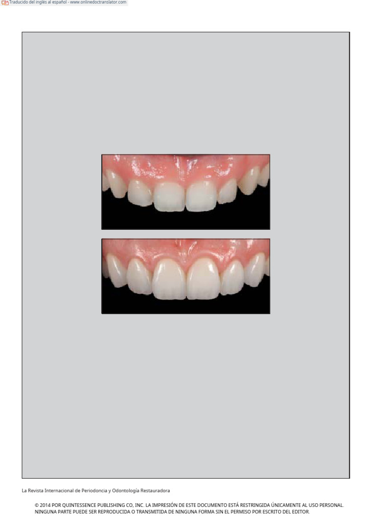 The Influence of Tooth Color On Preparation Design For Laminate Veneers ...