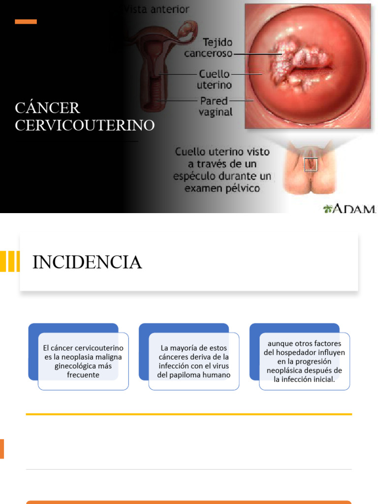 Cáncer Cervicouterino | PDF | Cáncer de cuello uterino | Cáncer