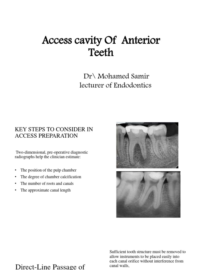 Access Cavity Preparation for Anterior Teeth | PDF | Tooth | Dentistry ...