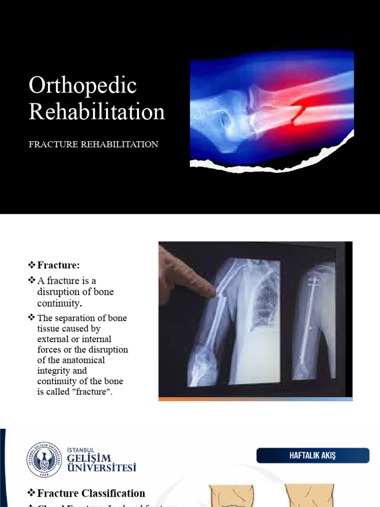 Fracture Rehabilitation | PDF | Bone | Knee