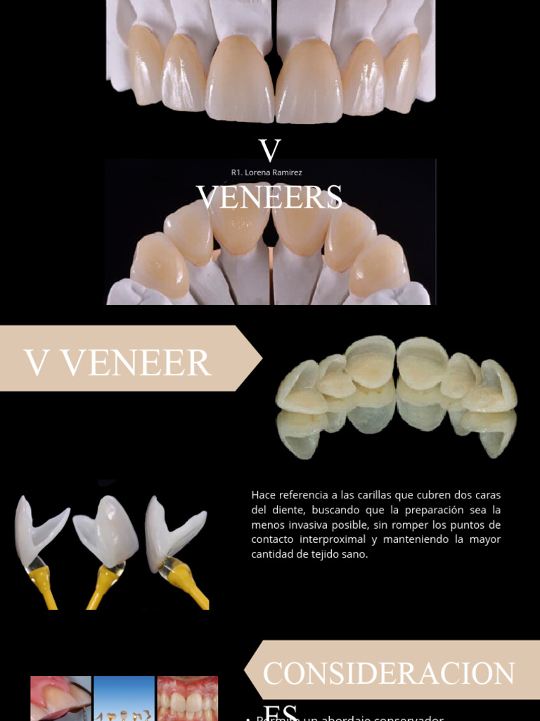 V Veneers - Revisión Literaria | PDF | Ramas de Odontología