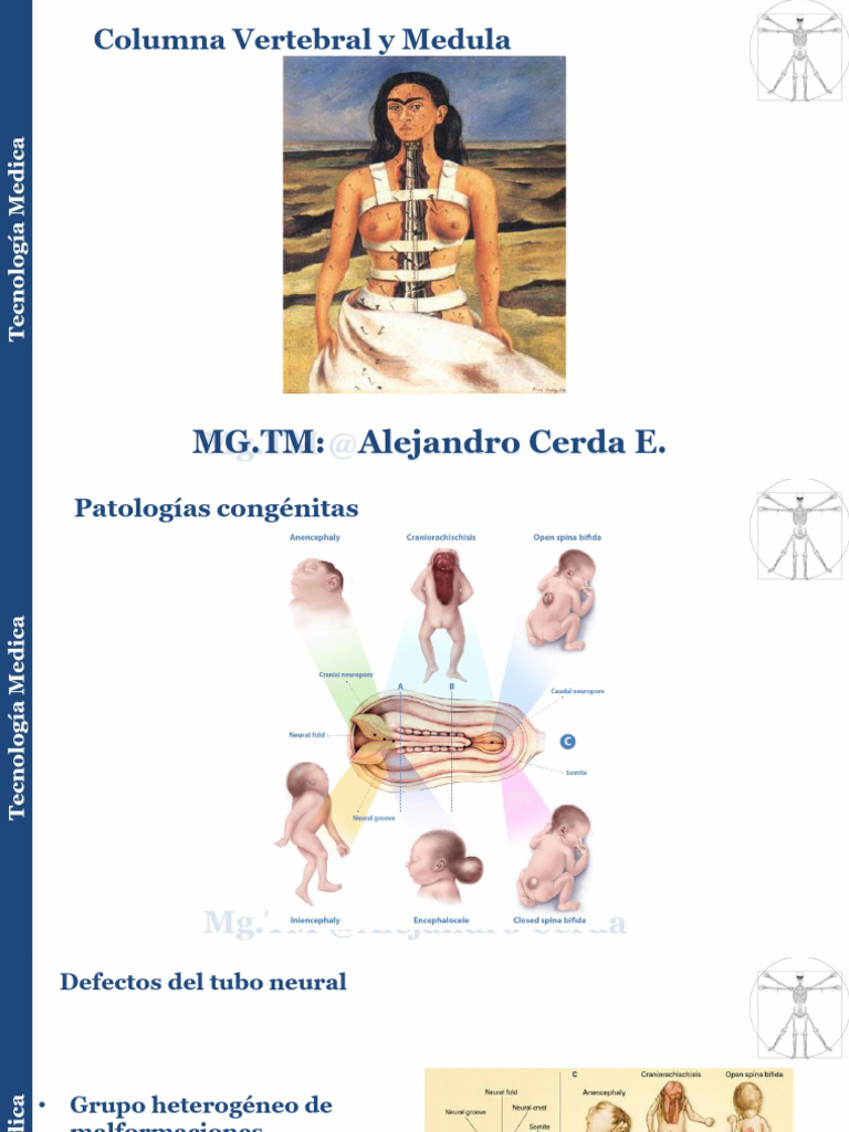 Medula Anclada y Disrafias Espinales | PDF | La columna vertebral ...