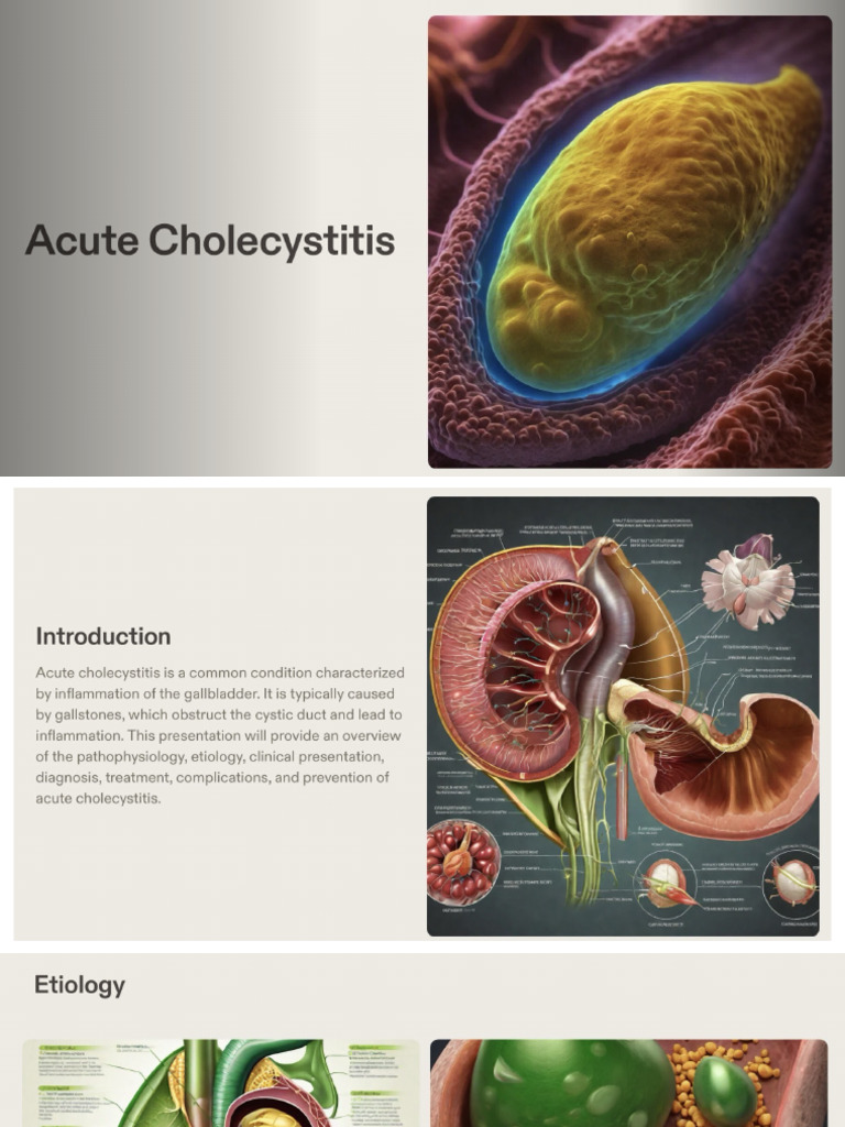 Acute cholecystitis | PDF