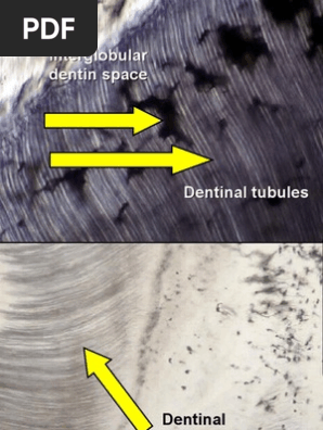 Interglobular Dentin