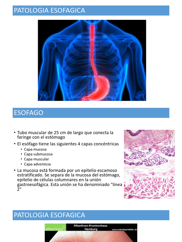 Patologías del Esófago y Disfagia | PDF | La enfermedad por reflujo ...