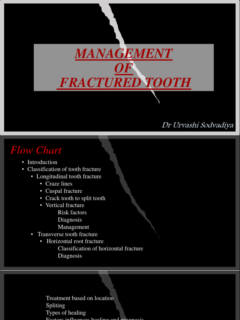 Management of Root Fracture | PDF | Tooth Enamel | Tooth