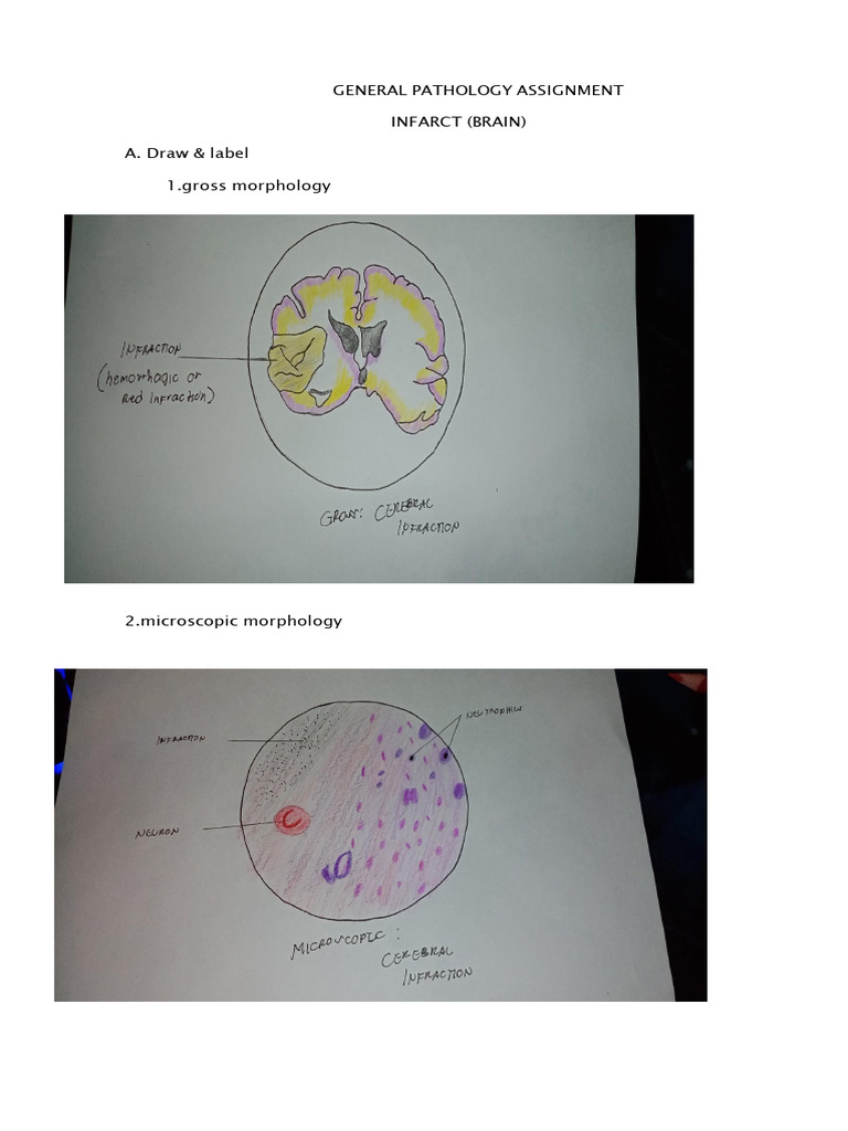 Camporedondo - Assignment - Cns (Infarct) | PDF
