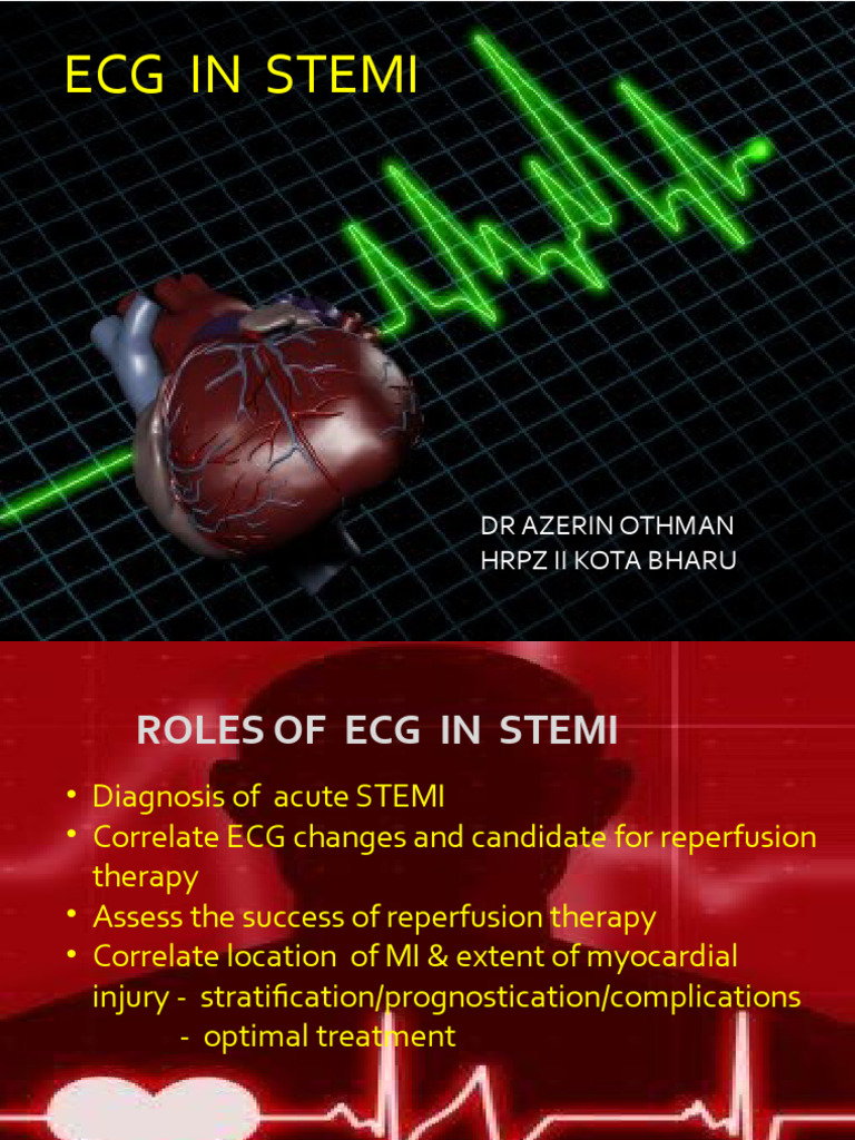 Ecg in Stemi DR Azerin | Download Free PDF | Electrocardiography ...