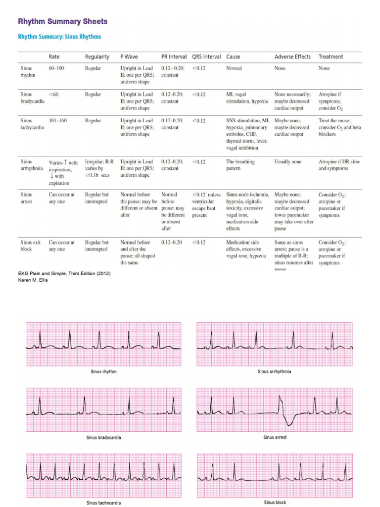 Rhythm Summary Review Packet EKG CLass | PDF | Electrocardiography ...