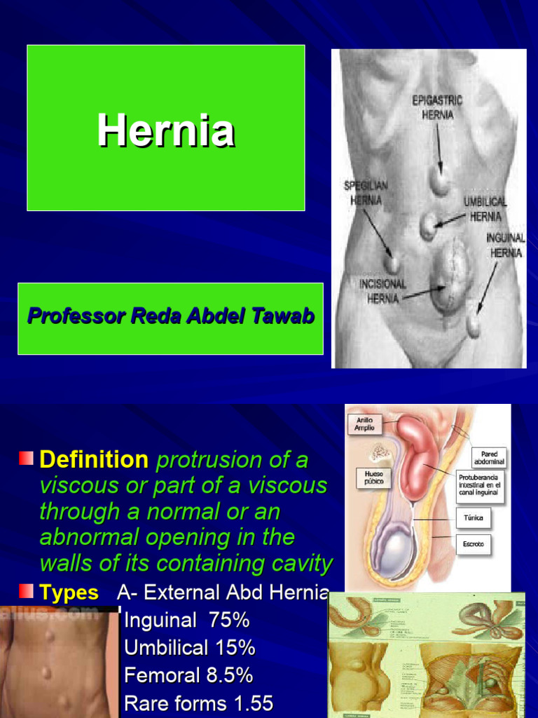 Hernia Powerpoint Pictoral Presentation | PDF