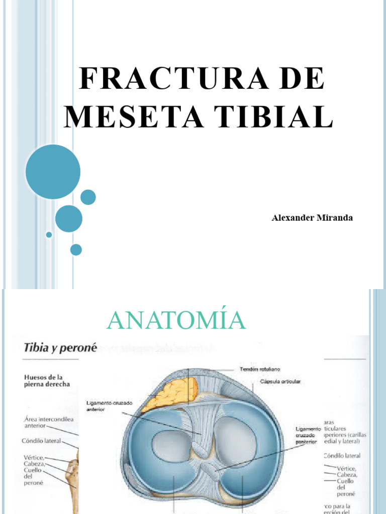 Fractura de Meseta Tibial 1 | PDF | Rodilla | Articulaciones