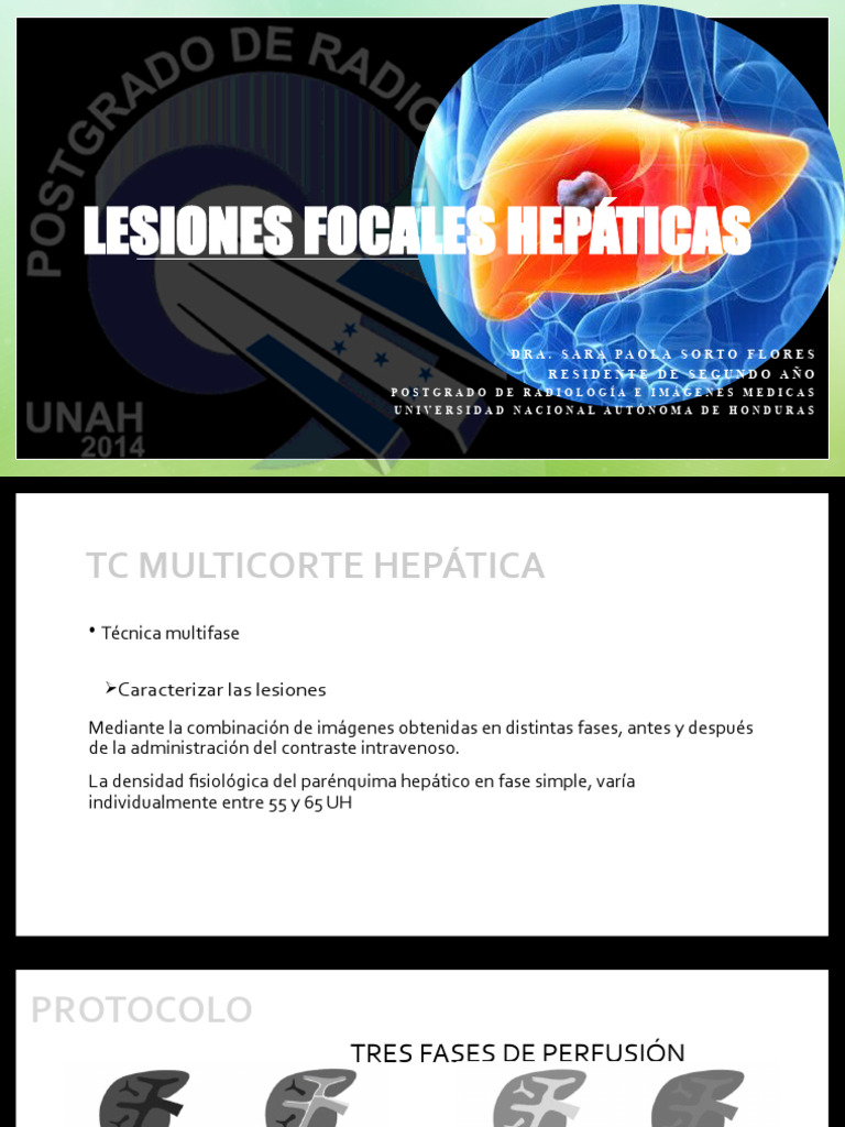Lesiones Focales Hepáticas Ss | PDF | Hígado | Medicina CLINICA