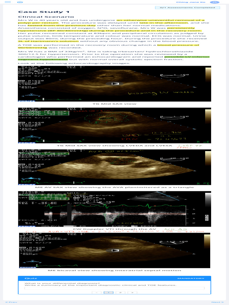 G1-3. Case Study 1 Q - Post-GA Dec Afterload | PDF