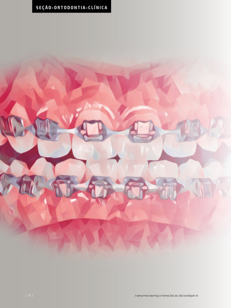 Tratamento de Classe II com Propulsor Mandibular | PDF | Dente | Áreas ...