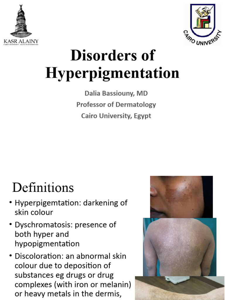 Disorders of Hyperpigmentation Handout | Download Free PDF | Sunscreen ...