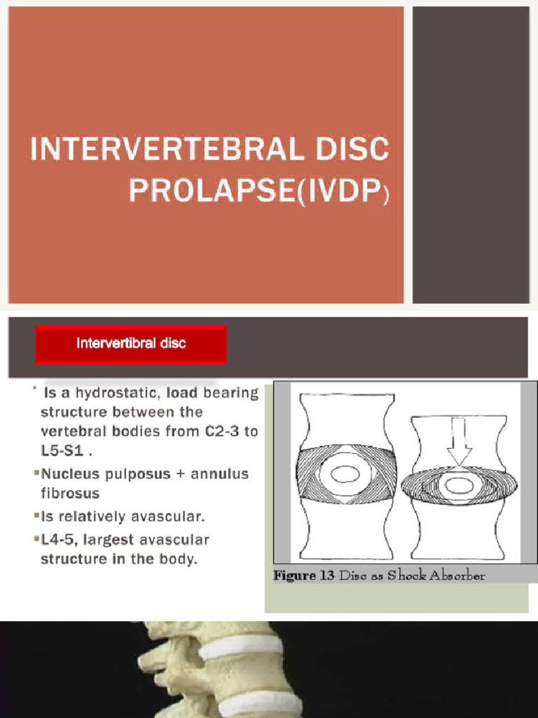 Ivdp | PDF