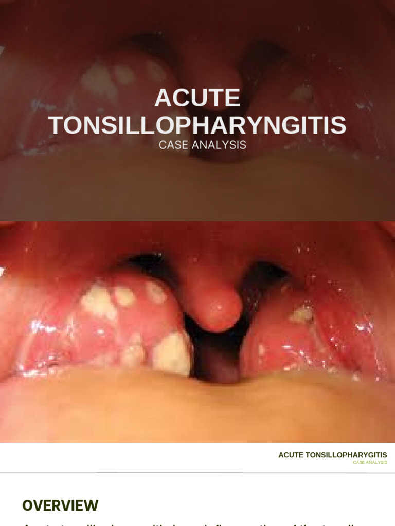 Acute Tonsillopharyngitis Case Analysis | PDF | Diseases And Disorders | Clinical Medicine