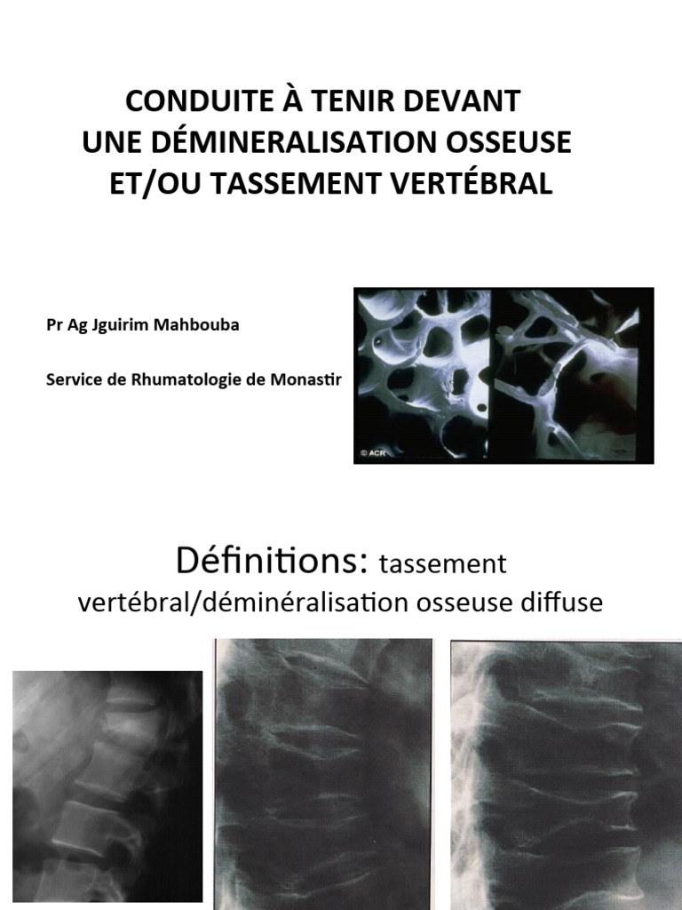 Déminéralisation osseuse et tassement vertébral | PDF | Ostéoporose ...