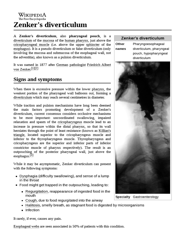 Zenker's Diverticulum | PDF | Esophagus | Human Anatomy