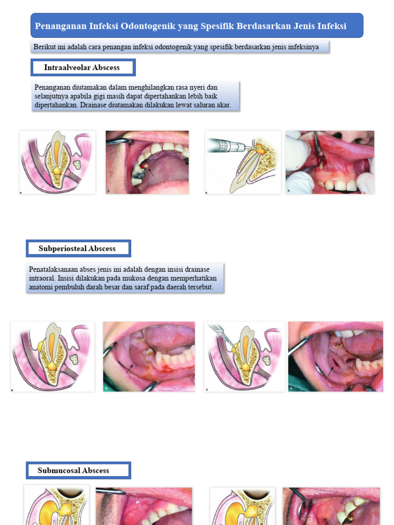Penanganan Infeksi Odontogenik Yang Spesifik Berdasarkan Jenis Infeksi | PDF
