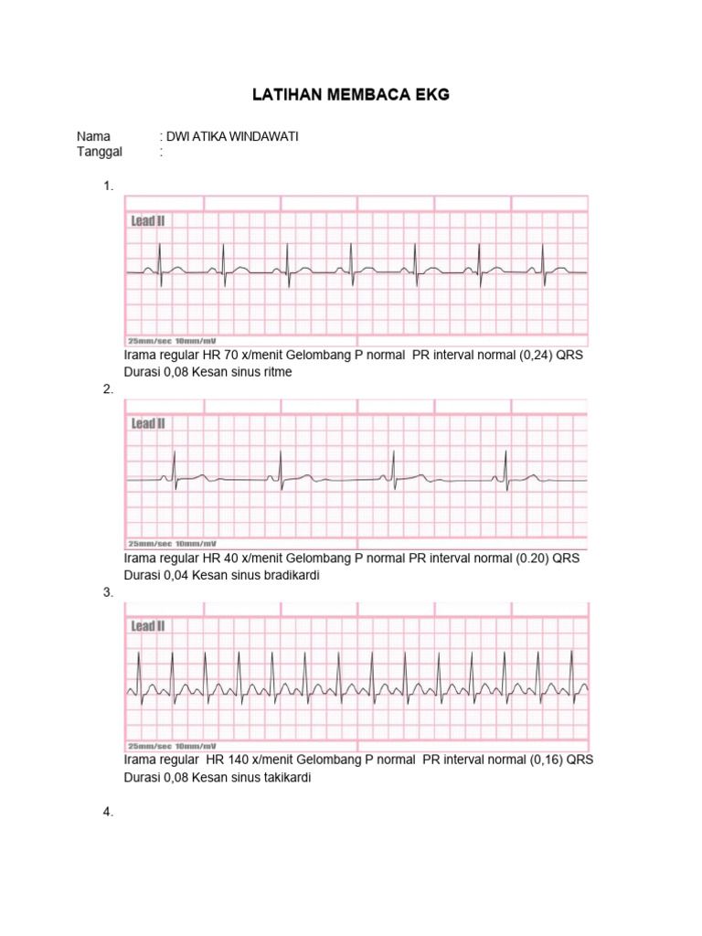 Latihan Membaca Ekg | PDF