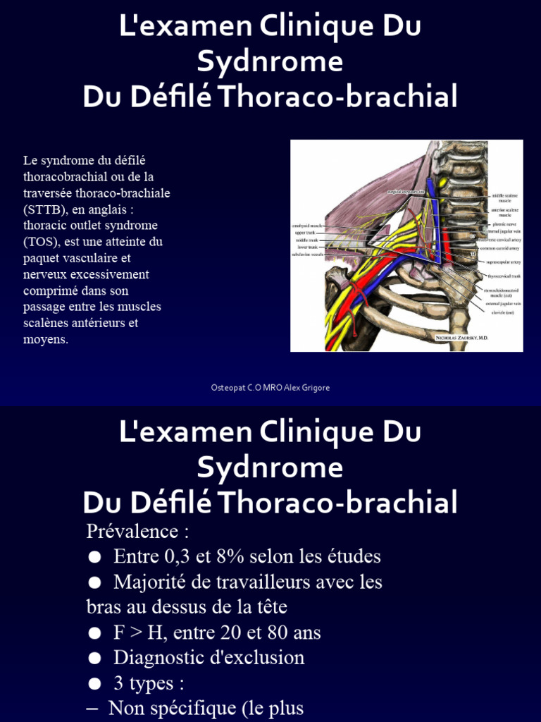 Syndrome Du Defile Thoraco Brachial | PDF | Syndrome | Neurologie