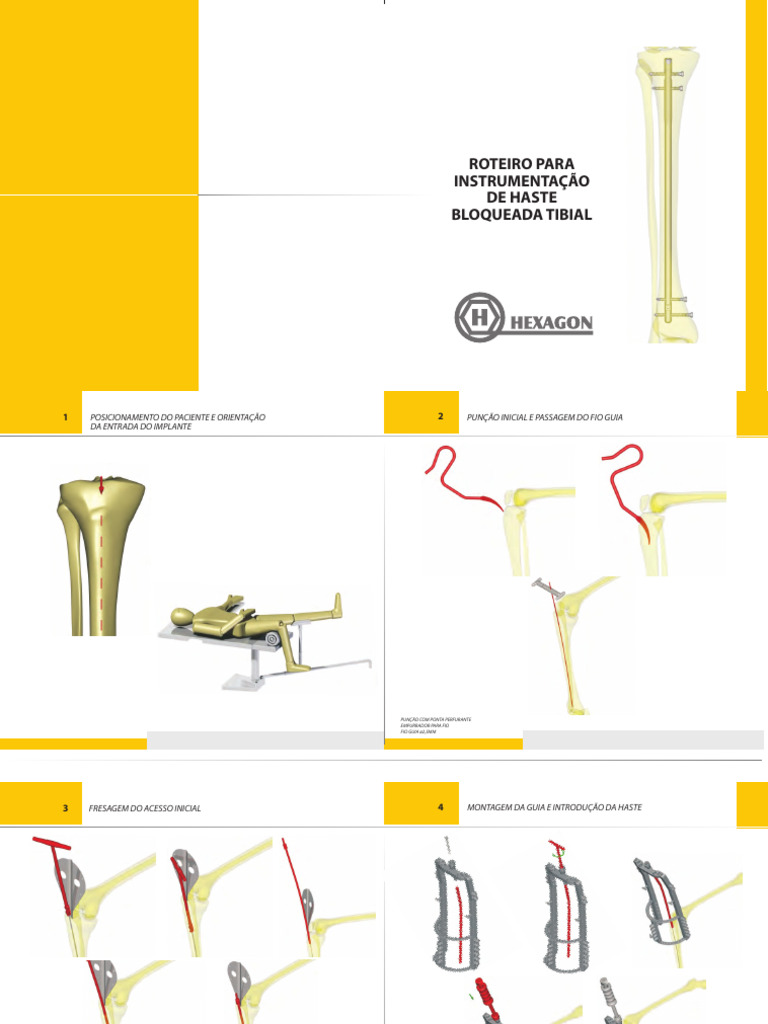 R - Técnica Haste Bloqueada Tibial | PDF