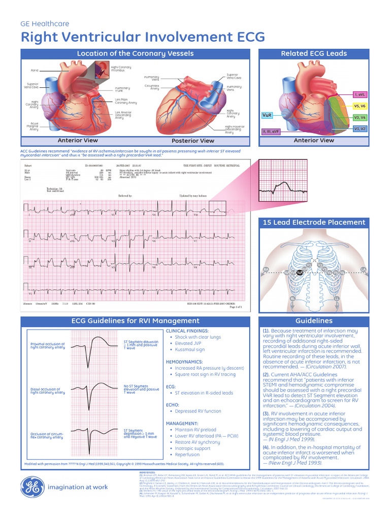 Right Ventricular Involvement Poster | PDF | Electrocardiography ...