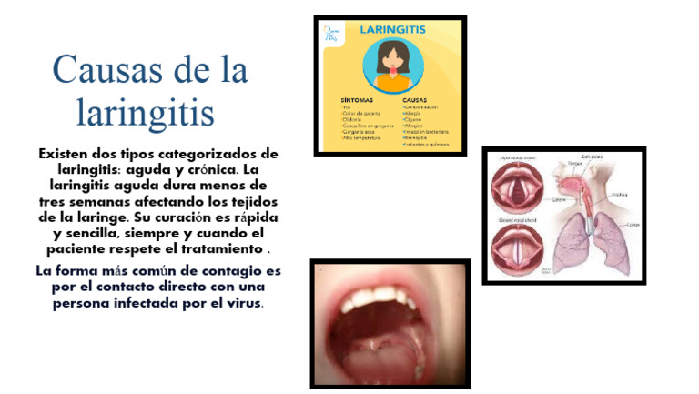 Laringitis, ¿Qué Es?, Síntomas, Causas, Prevención – SZJNU
