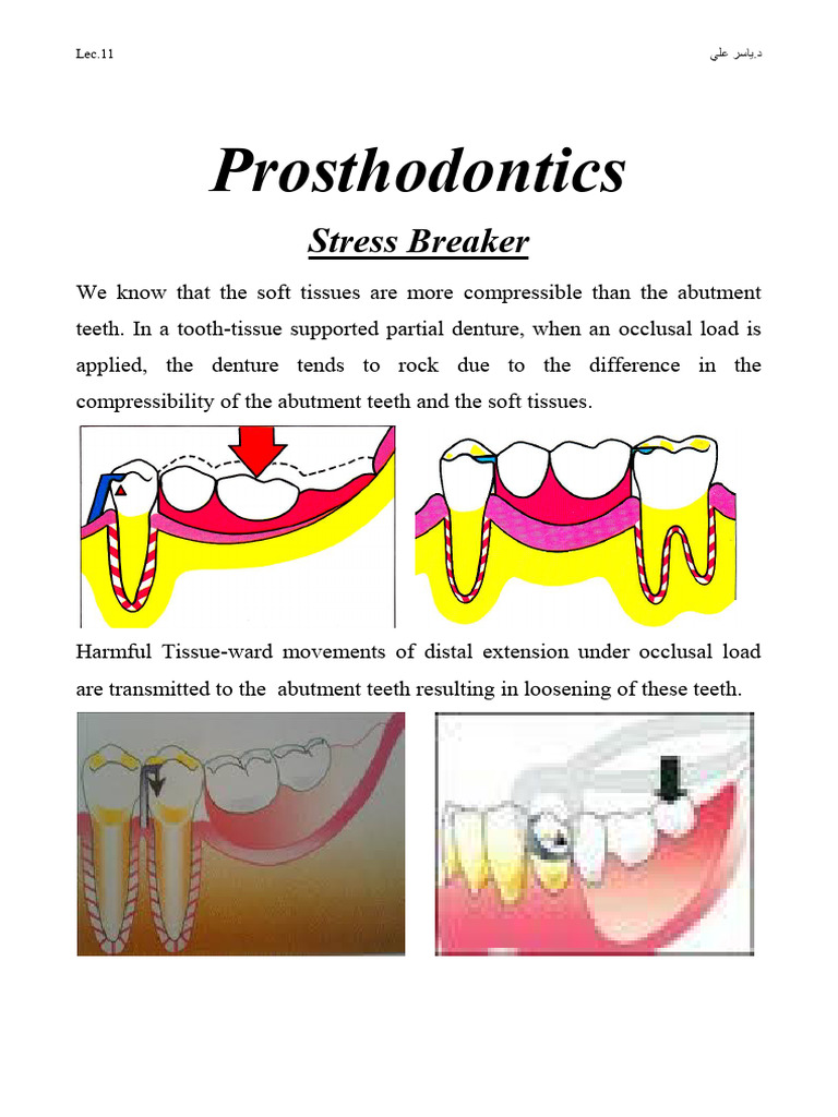 Stress Breakers in Prosthodontics | PDF | Dentures | Dentistry Branches